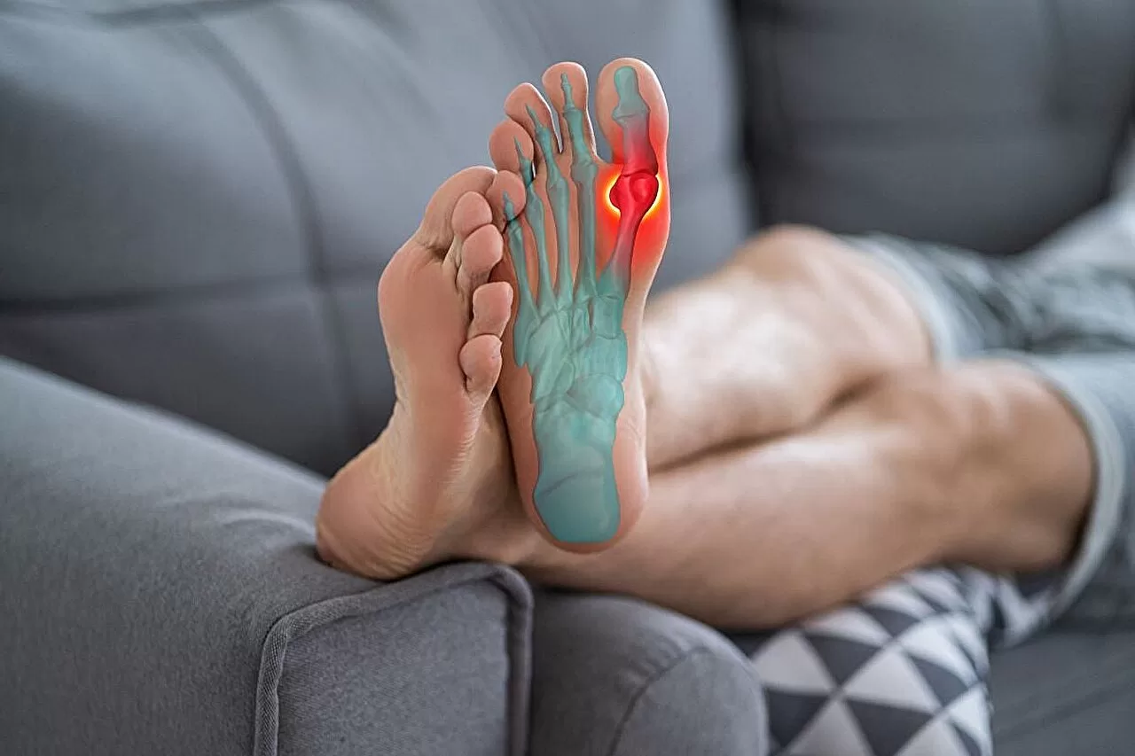 Greater Alcohol Intake Linked to Higher Gout Risk, Study Finds ...
