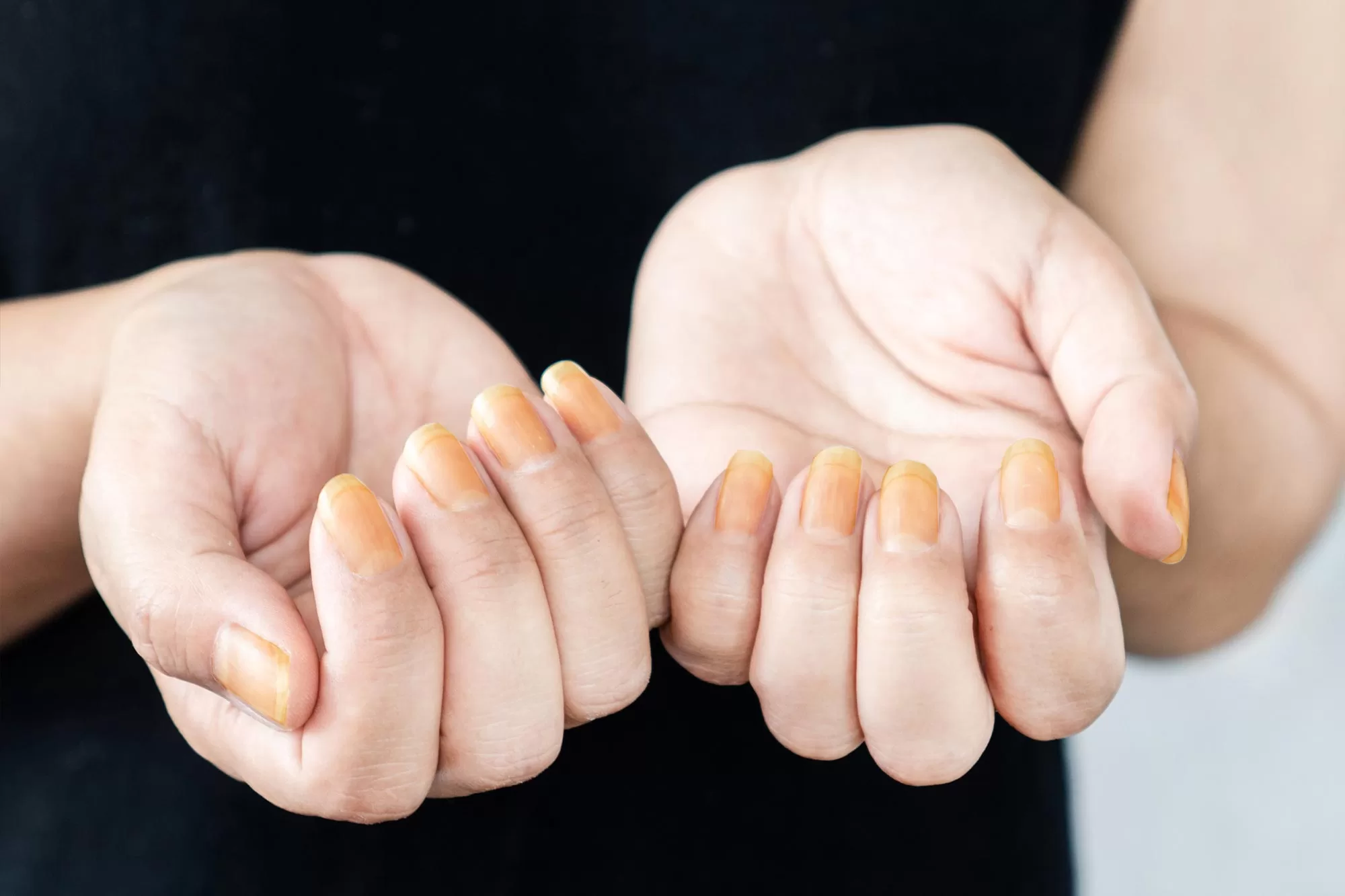 Scientists Discover Key Cause of Yellow Nail Syndrome - Prevention is ...