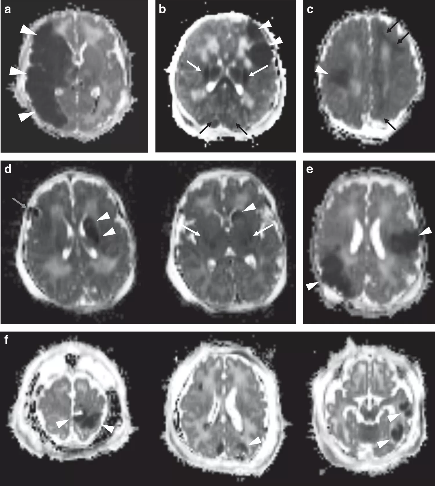 MRI Study Reveals Overlap Between Two Common Neonatal Brain Injuries ...